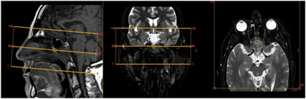 MR Pediatric Brain and Orbits WWO Neuro Protocol | OHSU